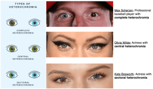 Heterochromia: Seeing the world through different colored eyes | Lions ...