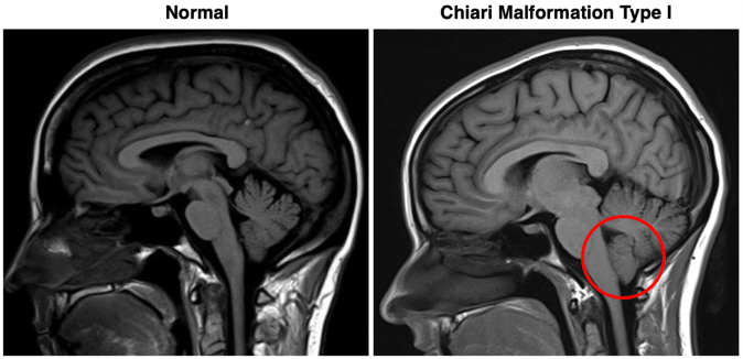Under Pressure: The Diary of a Chiari Malformation | Lions Talk Science